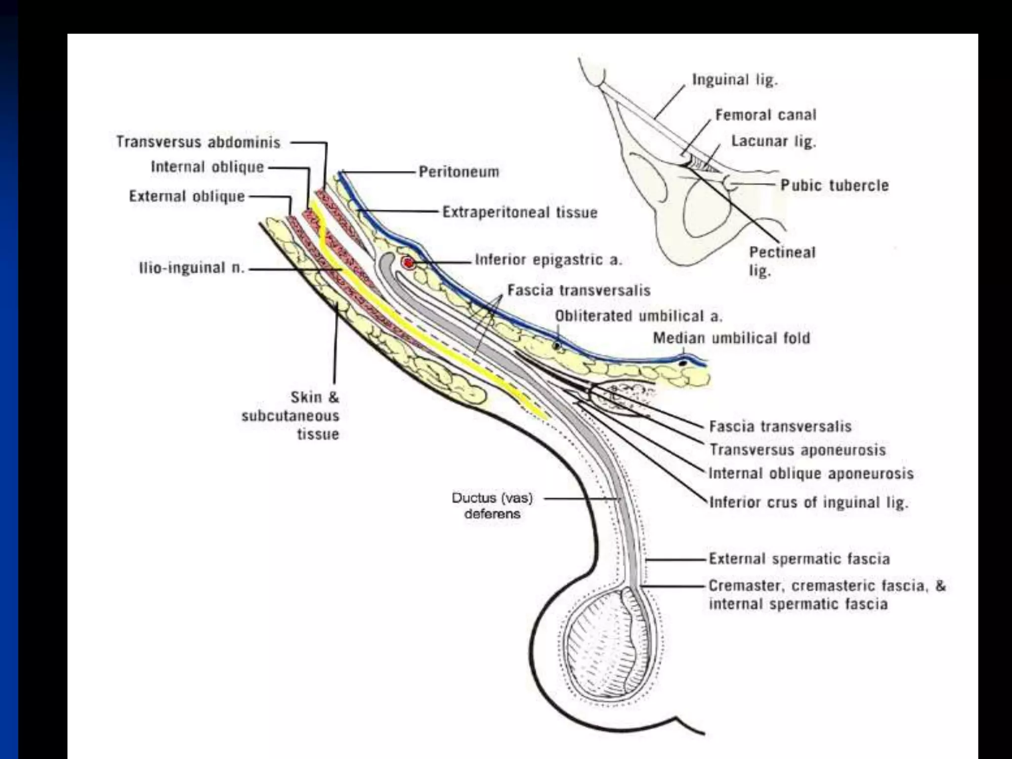 Basics of inguinal hernias | PPT