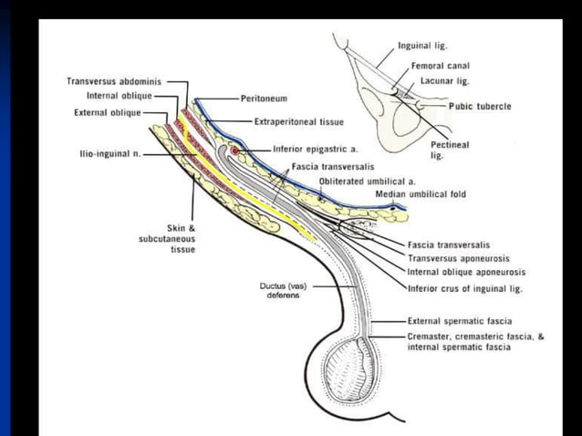 Basics of inguinal hernias | PPT | Death, Injury, or Military Conflict ...