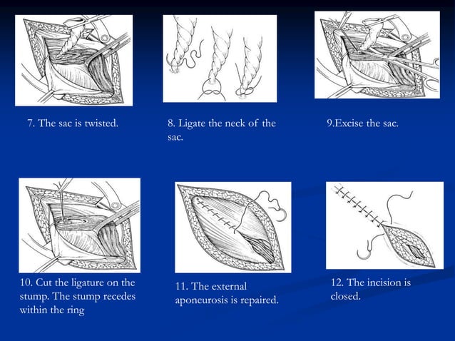Basics of inguinal hernias | PPT | Death, Injury, or Military Conflict ...