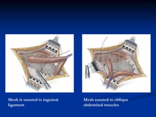 Basics of inguinal hernias | PPT