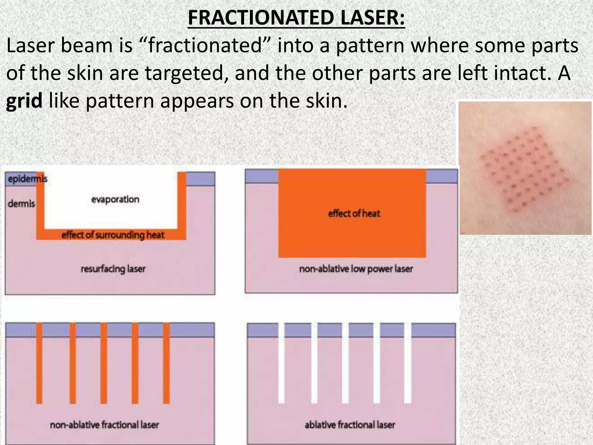 Basics of lasers | PPTX