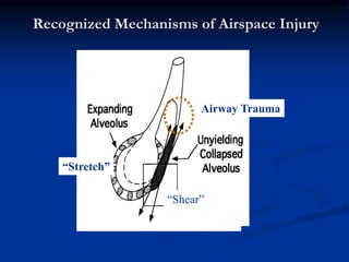 Basics of mechanical ventilation | PPSX