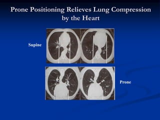 Basics of mechanical ventilation | PPSX