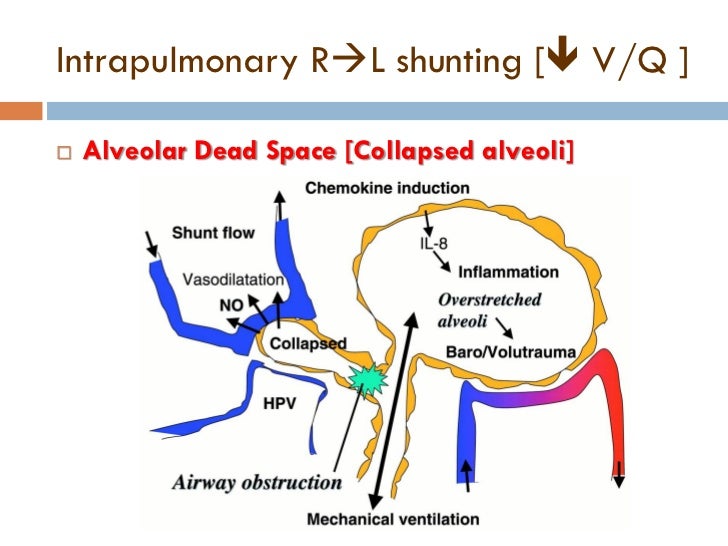 Basics of neonatal ventilation 1