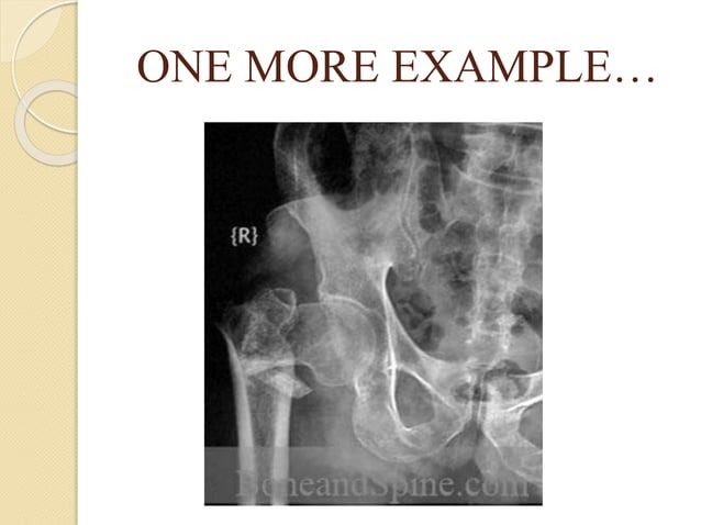 basics of orthopedic radiology.ppt | Death, Injury, or Military ...