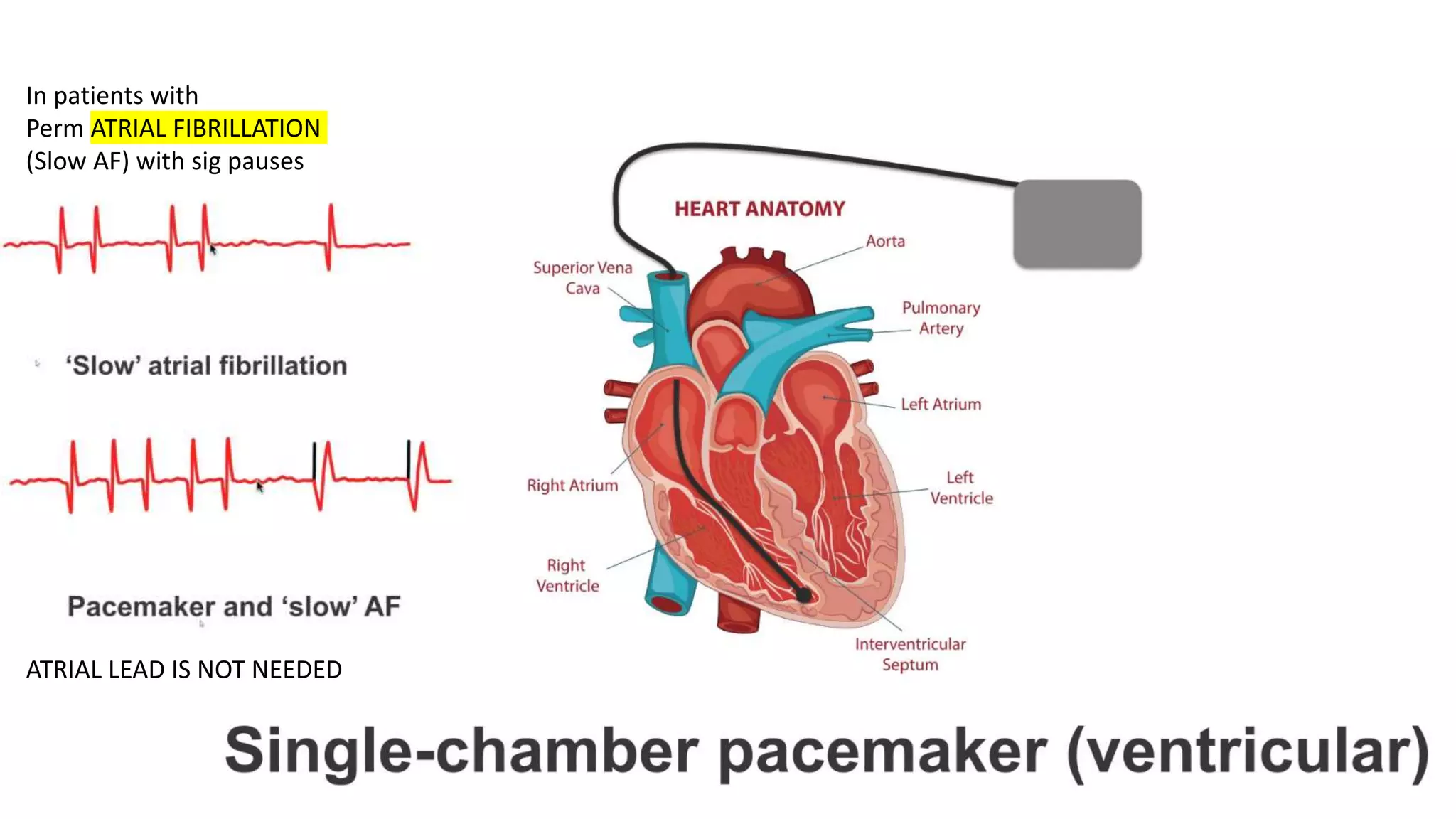 Basics of Pacemaker Dr Hafeesh Fazulu Pushpagiri | PPTX
