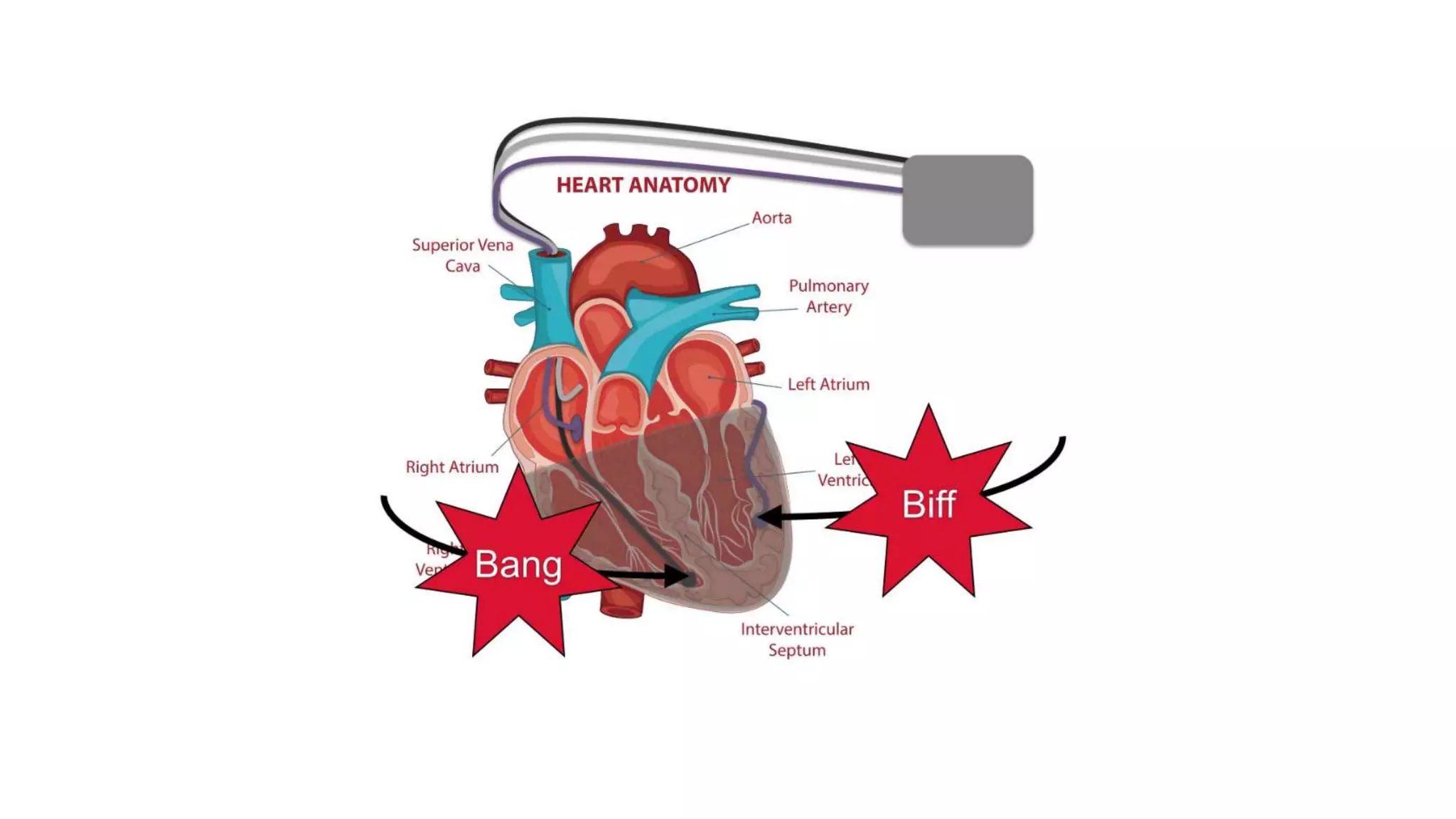 Basics of Pacemaker Dr Hafeesh Fazulu Pushpagiri | PPTX