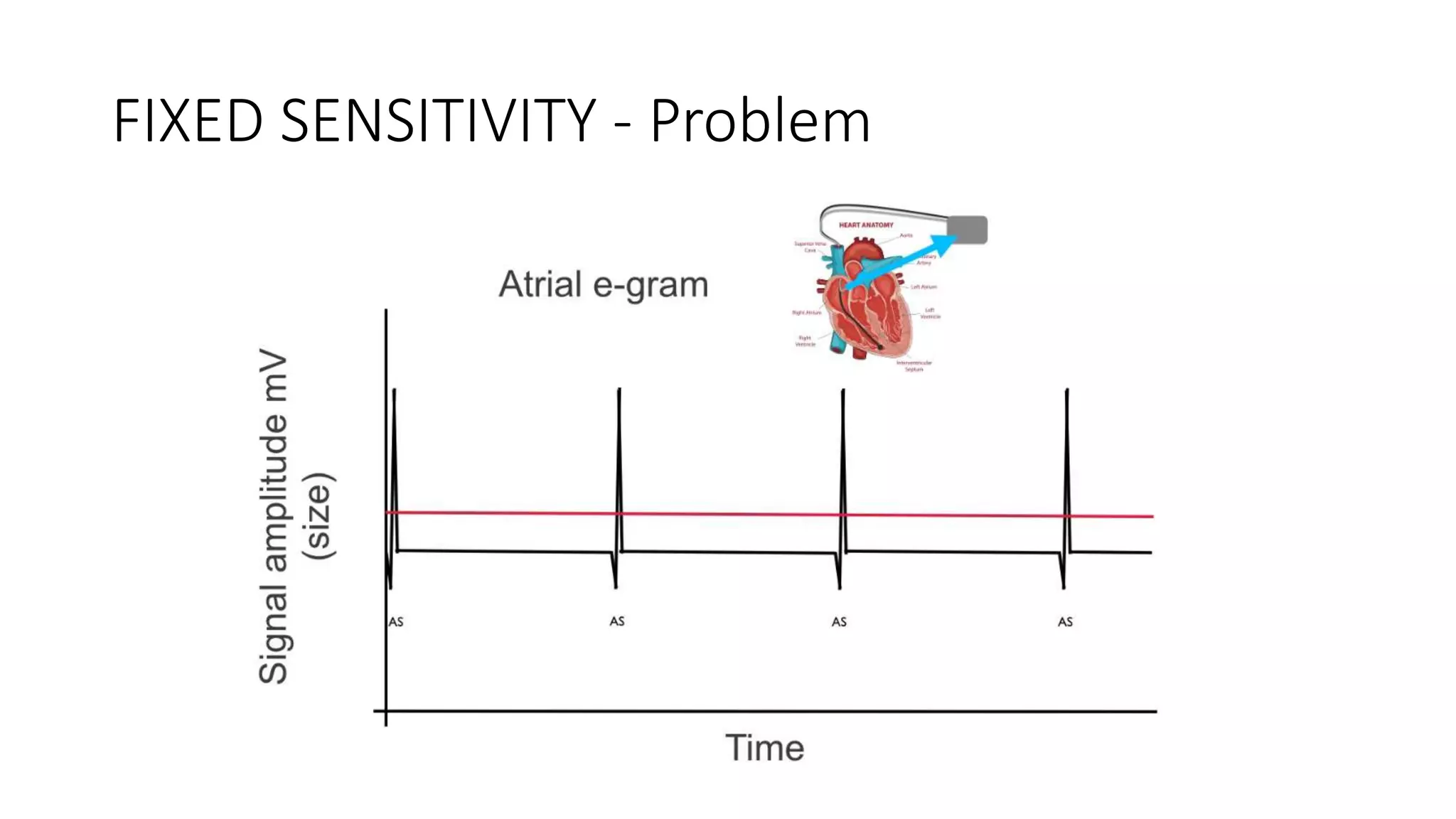 Basics of Pacemaker Dr Hafeesh Fazulu Pushpagiri | PPTX
