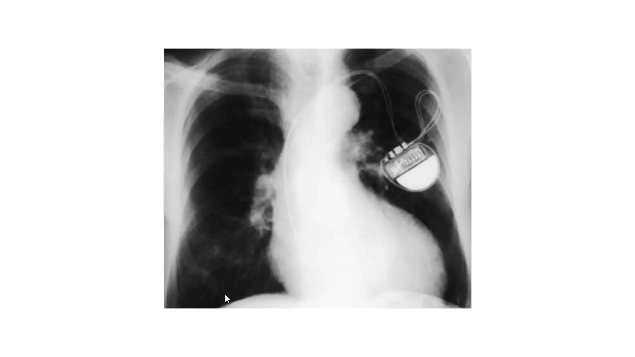 Basics of Pacemaker Dr Hafeesh Fazulu Pushpagiri | PPTX
