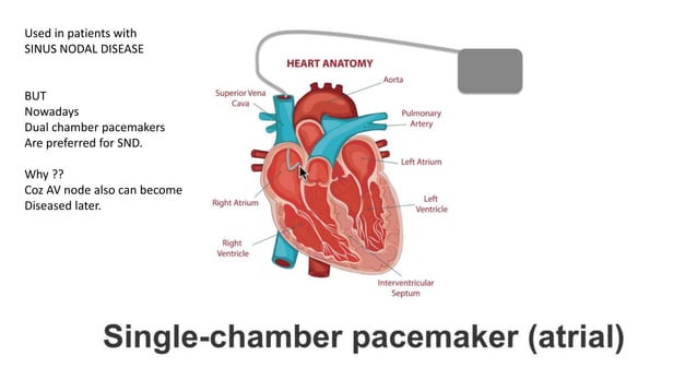 Basics of Pacemaker Dr Hafeesh Fazulu Pushpagiri | PPTX | Heart and ...