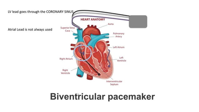 Basics of Pacemaker Dr Hafeesh Fazulu Pushpagiri | PPTX | Heart and ...
