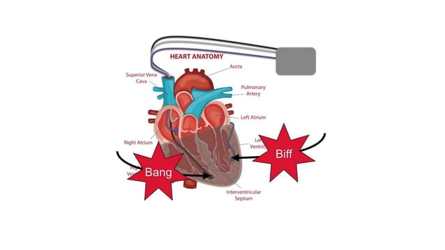Basics of Pacemaker Dr Hafeesh Fazulu Pushpagiri | PPTX | Heart and ...