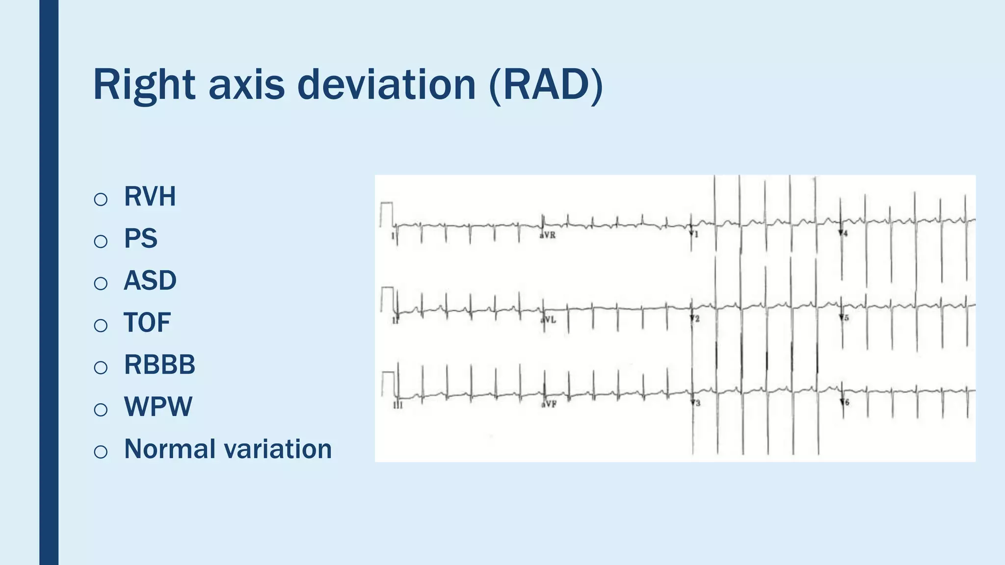 Basics of Paediatric ECG | PPTX