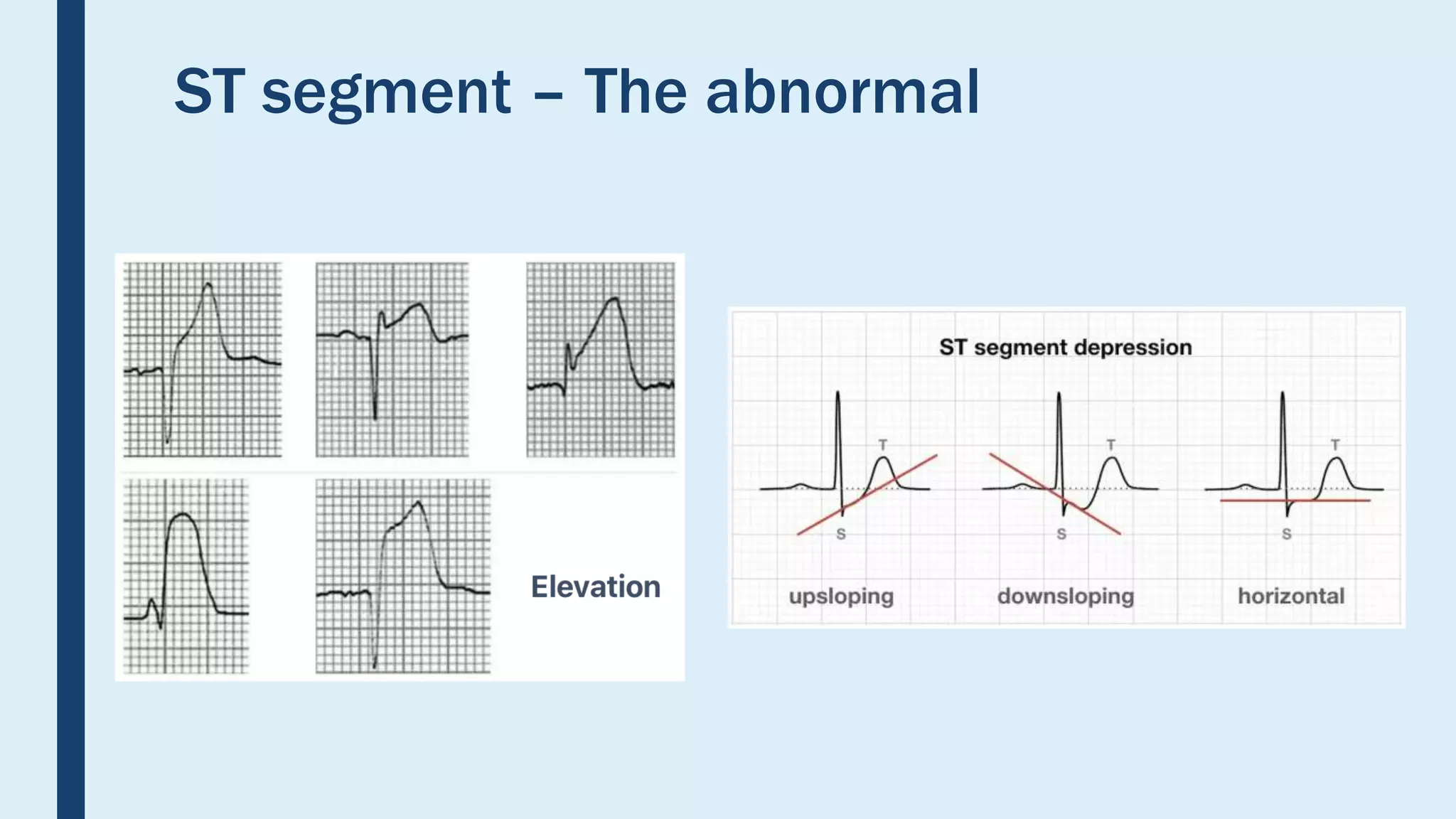 Basics of Paediatric ECG | PPTX