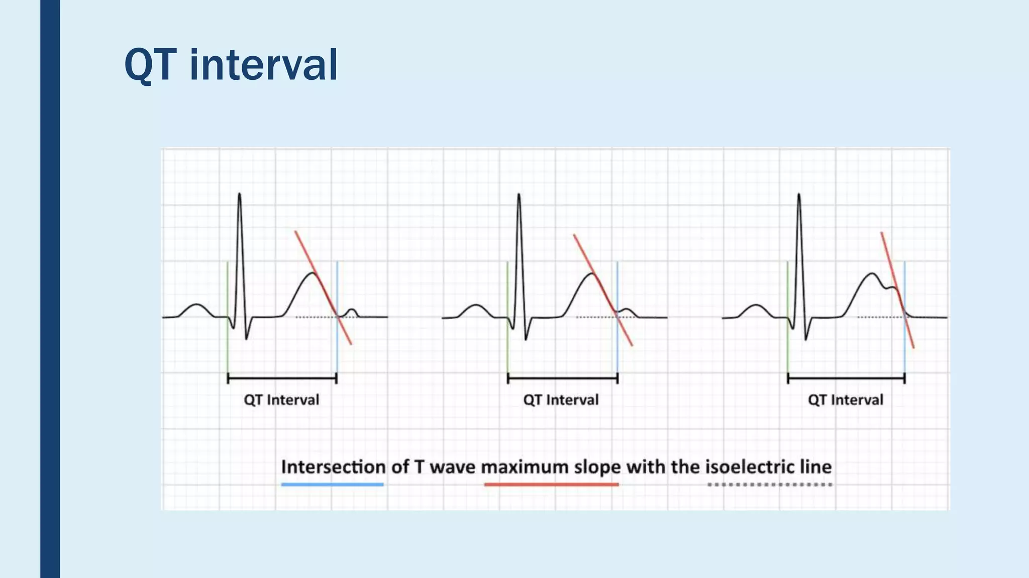 Basics of Paediatric ECG | PPTX