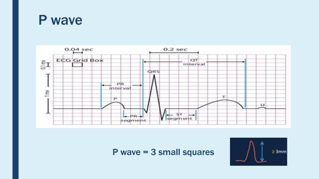 Basics of Paediatric ECG | PPTX