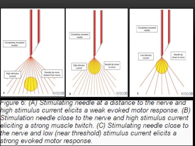 Basics of peripheral nerve stimulation | PPTX | First Aid | Injuries