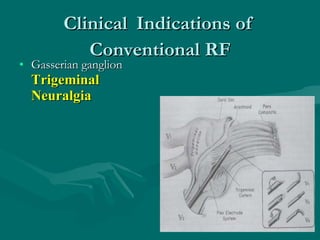 Basics of radio frequency techniques in pain management jadon.a | PPT
