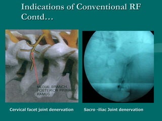 Basics of radio frequency techniques in pain management jadon.a | PPT