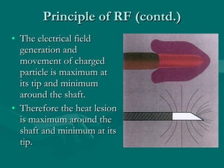 Basics of radio frequency techniques in pain management jadon.a | PPT
