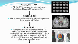BASICS OF RADIATION THERAPY/RADIATION ONCOLOGY | PPTX