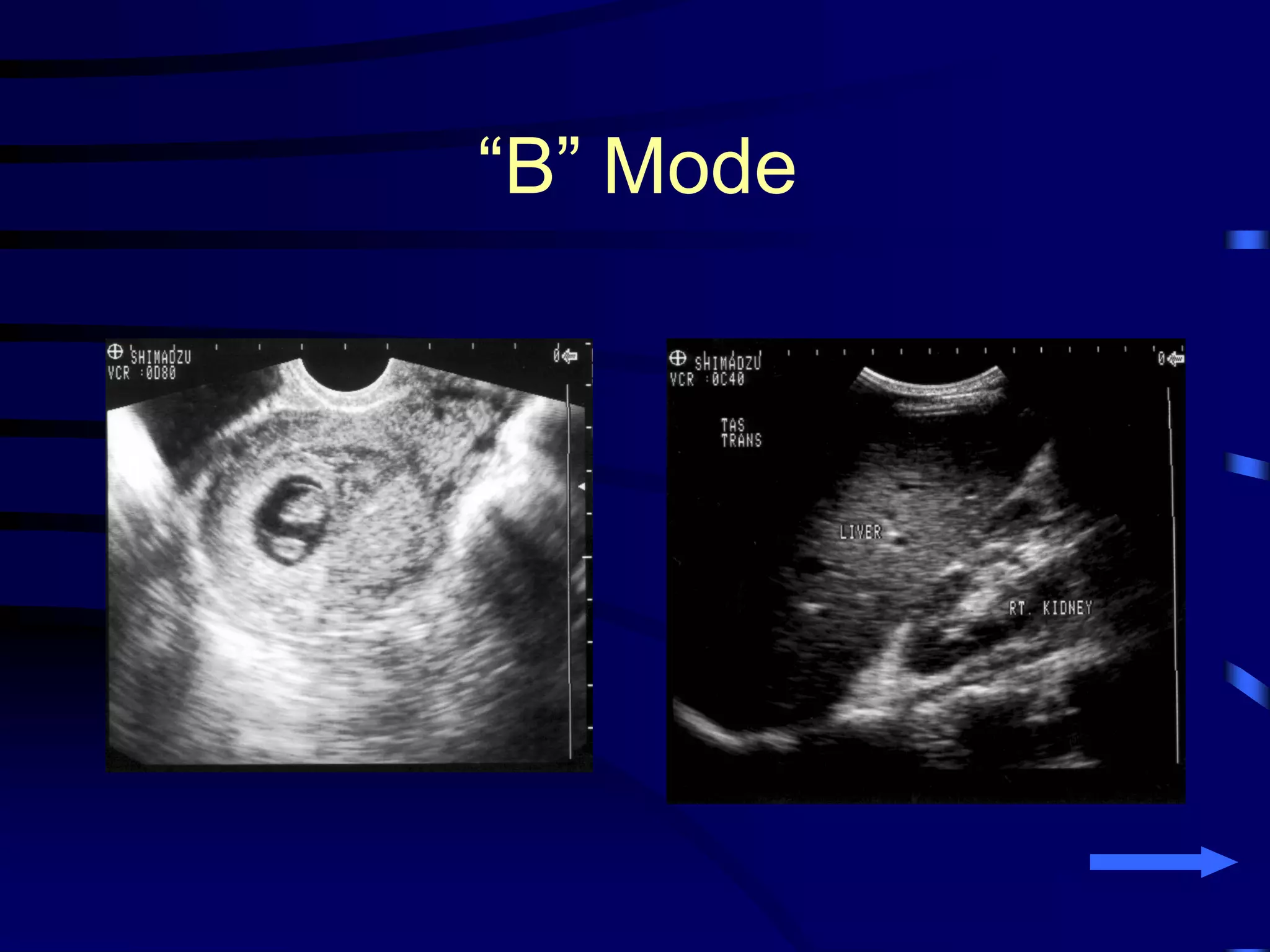 Basics of Chest Sonography and Anatomy of Chest Wall | PDF | Lung and ...