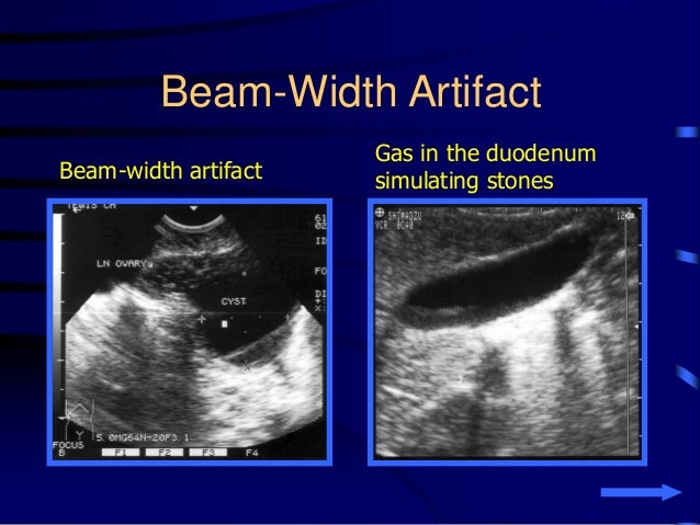 Basics of Chest Sonography and Anatomy of Chest Wall