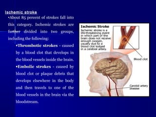 Basics of stroke(CVA) Management | PPT