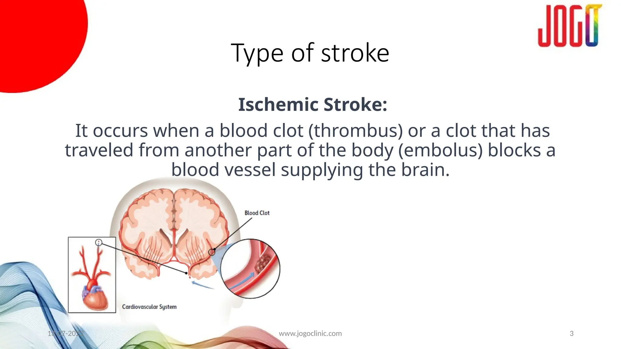 Basics of stroke- Types ischemic and hemorrhagic .pptx | Brain and Nervous System Disorders ...