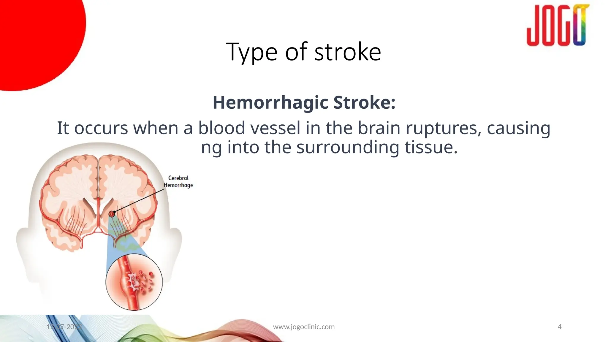 Basics of stroke- Types ischemic and hemorrhagic .pptx | Brain and Nervous System Disorders ...