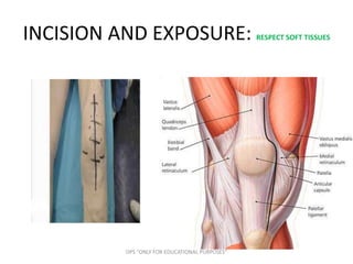 BASICS OF TKR BY DR. D. P. SWAMI | PPTX