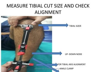 BASICS OF TKR BY DR. D. P. SWAMI | PPTX