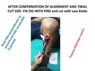 BASICS OF TKR BY DR. D. P. SWAMI | PPTX