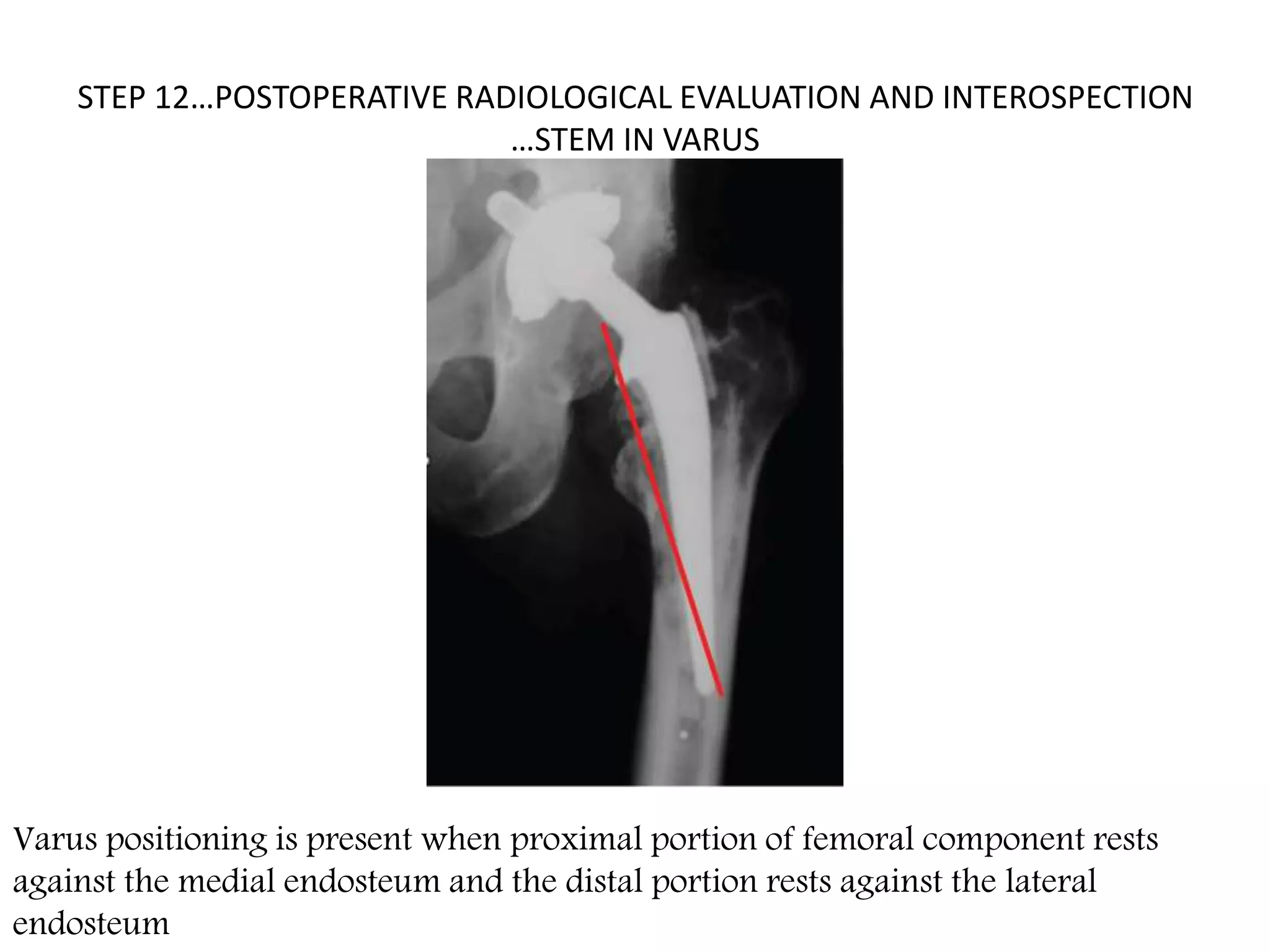 Basics of total hip replacement by DR. D. P. SWAMI | PPTX