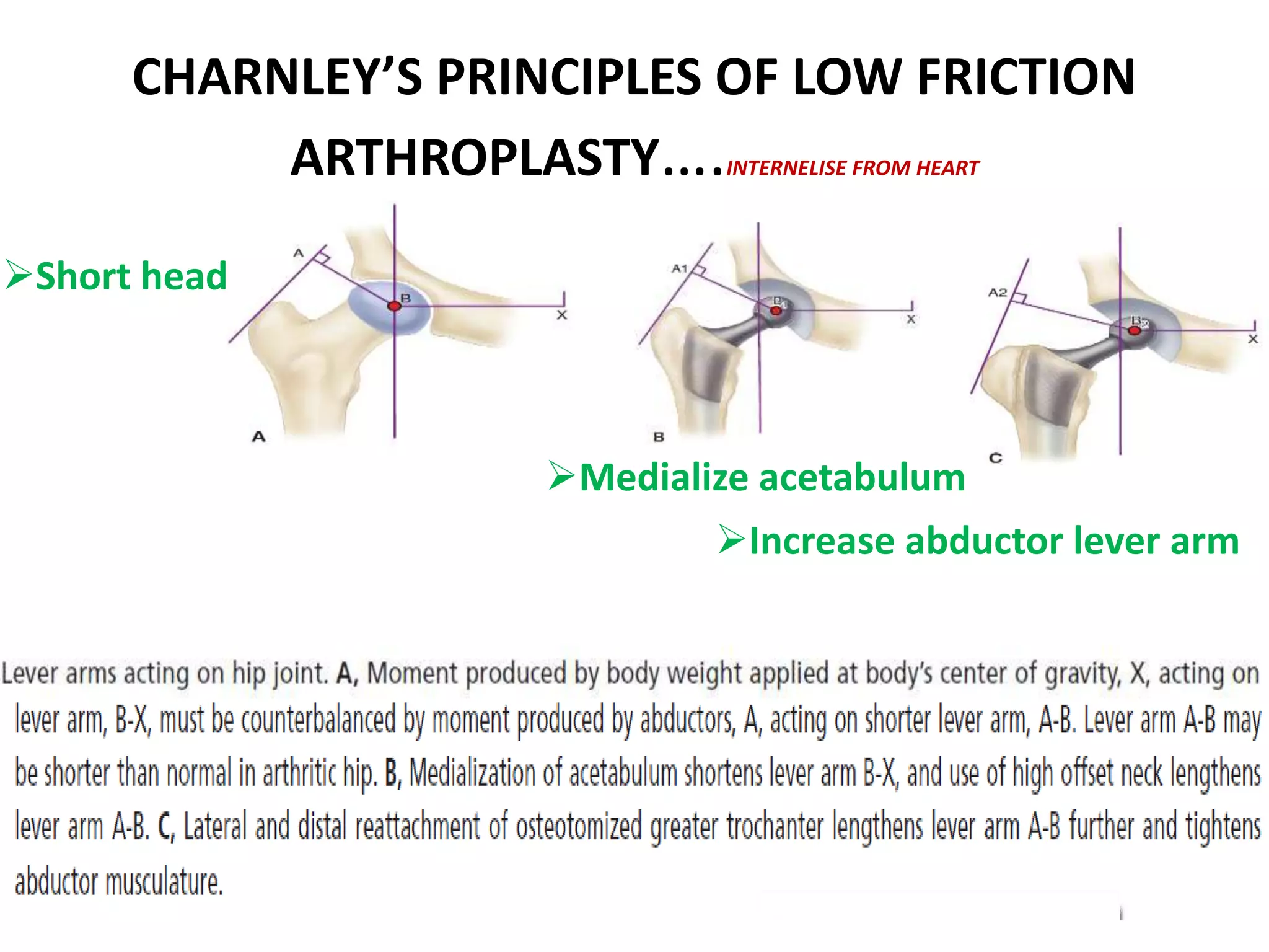 Basics of total hip replacement by DR. D. P. SWAMI | PPTX