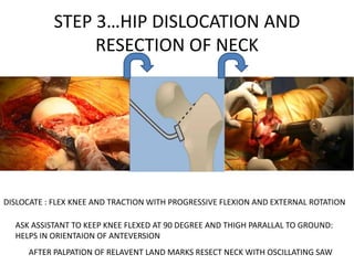 Basics of total hip replacement by DR. D. P. SWAMI | PPTX