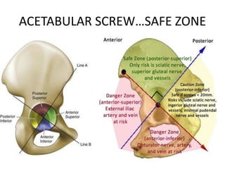 Basics of total hip replacement by DR. D. P. SWAMI | PPTX