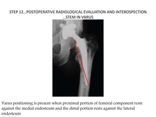 Basics of total hip replacement by DR. D. P. SWAMI | PPTX
