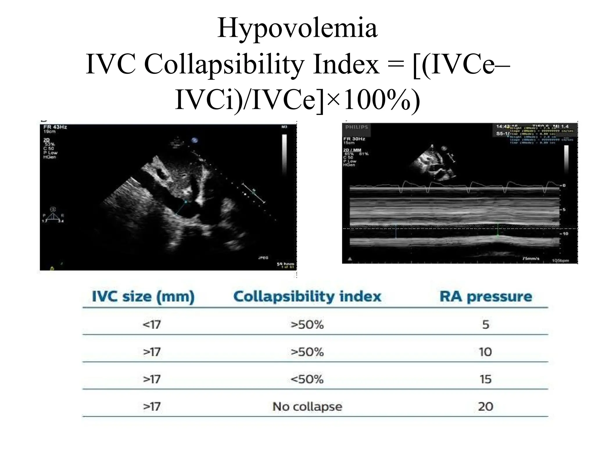 BASICS OF TTE & TEE trans esophageal echo.pptx
