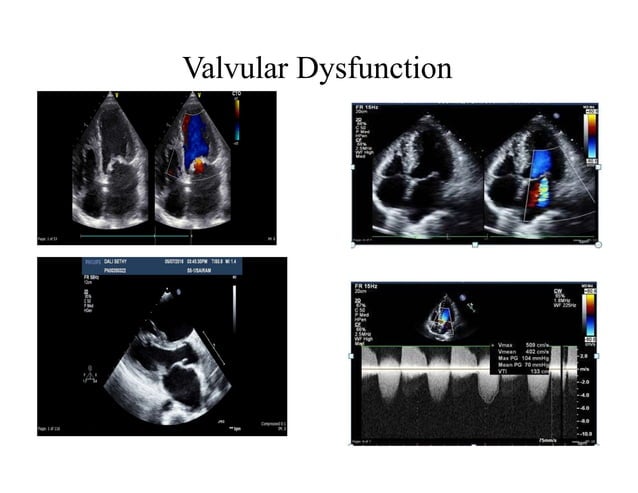 BASICS OF TTE & TEE trans esophageal echo.pptx