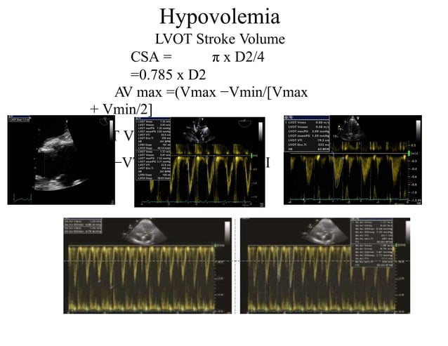 BASICS OF TTE & TEE trans esophageal echo.pptx