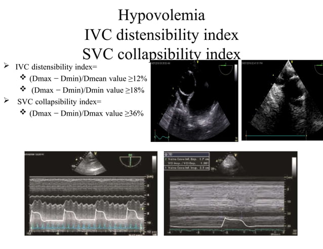 BASICS OF TTE & TEE trans esophageal echo.pptx