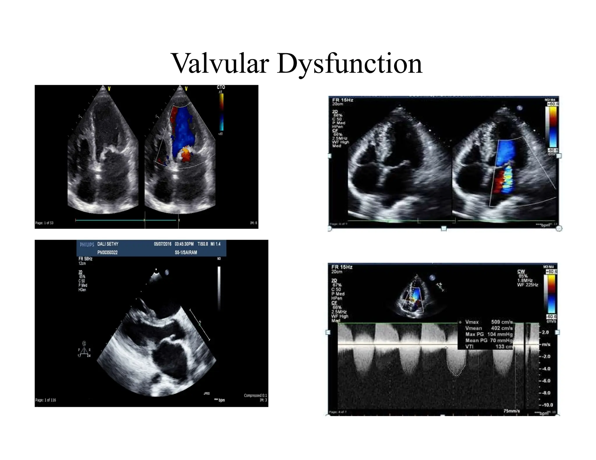 BASICS OF TTE trans tracheal echo& TEE.pptx