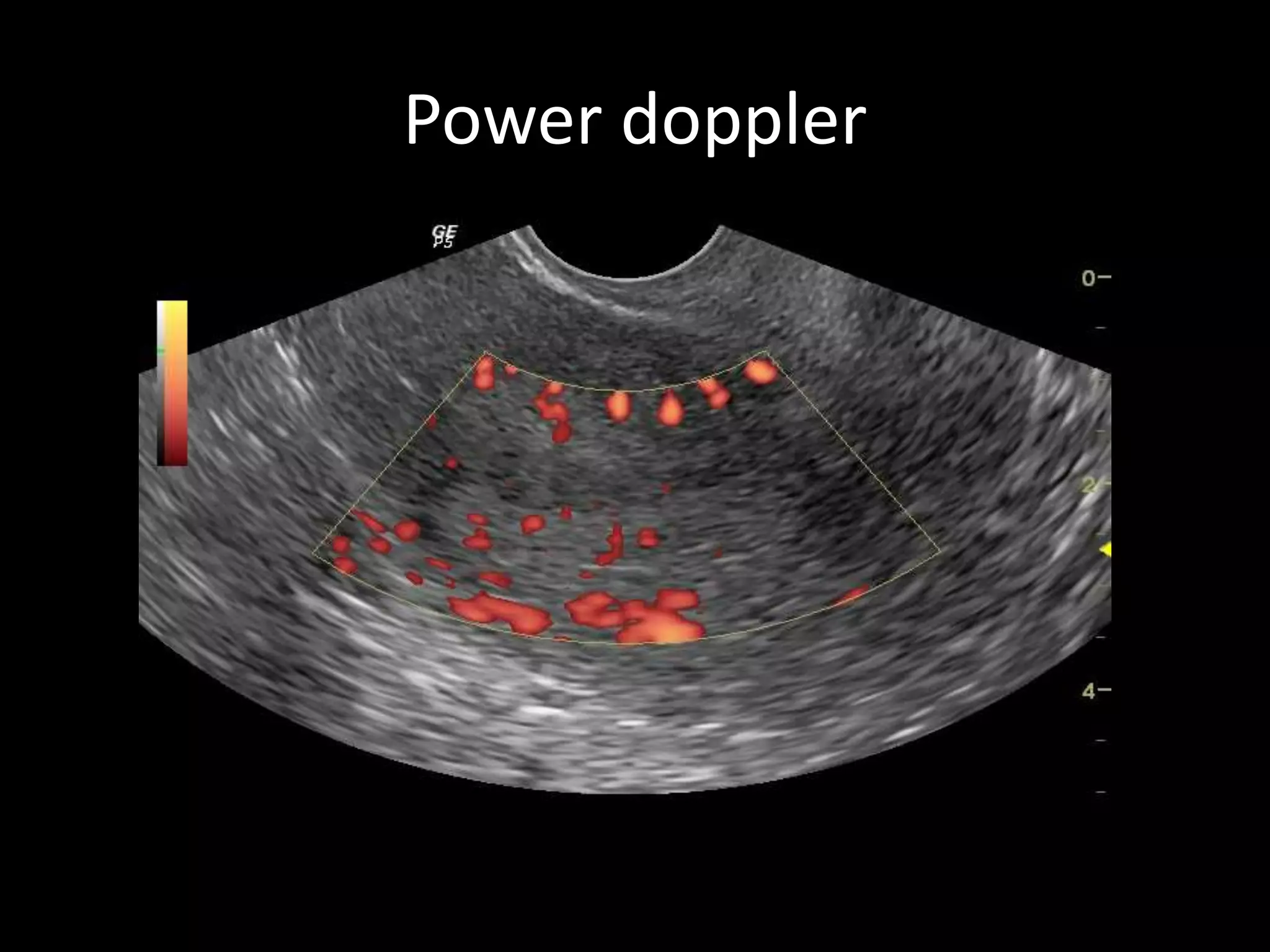 Basics of tvs color doppler | PPTX