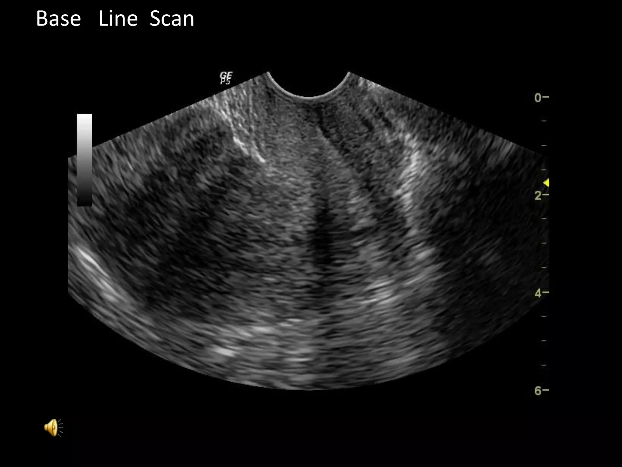 Basics of tvs color doppler | PPTX