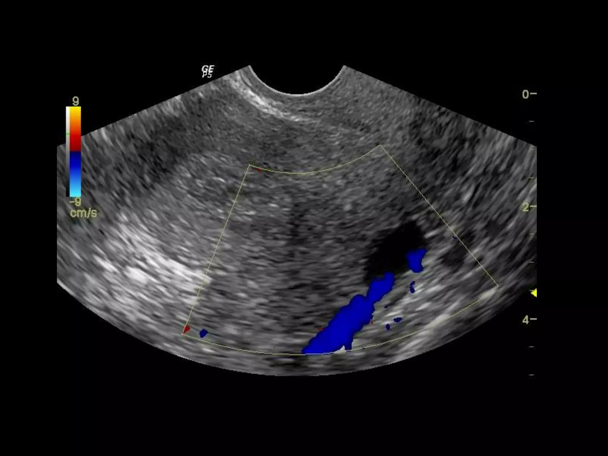Basics of tvs color doppler | PPTX