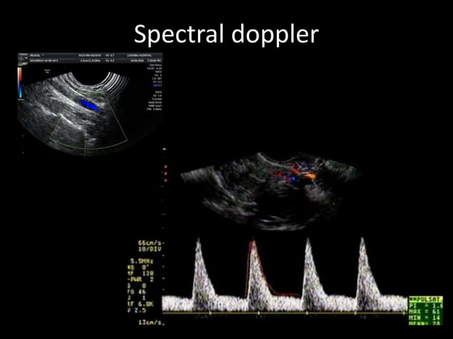 Basics of tvs color doppler | PPT
