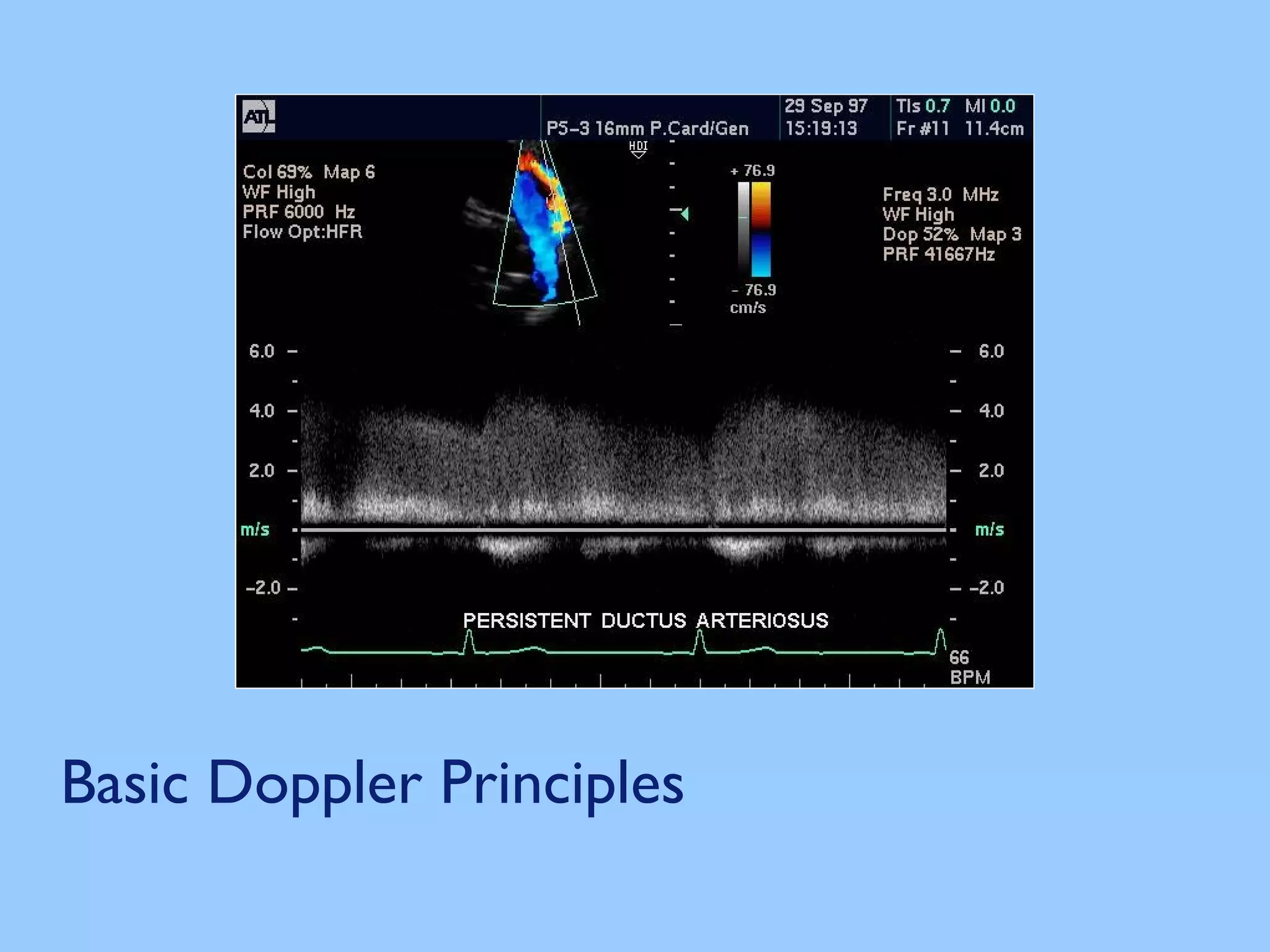 Basics Physics of ultrasound | PPT