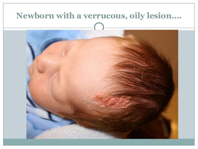 Movable lump on back of babys head - lokipeak