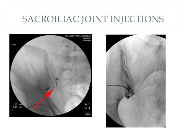Sacroiliac Joint Injection Technique Approach Shoulder Injection: